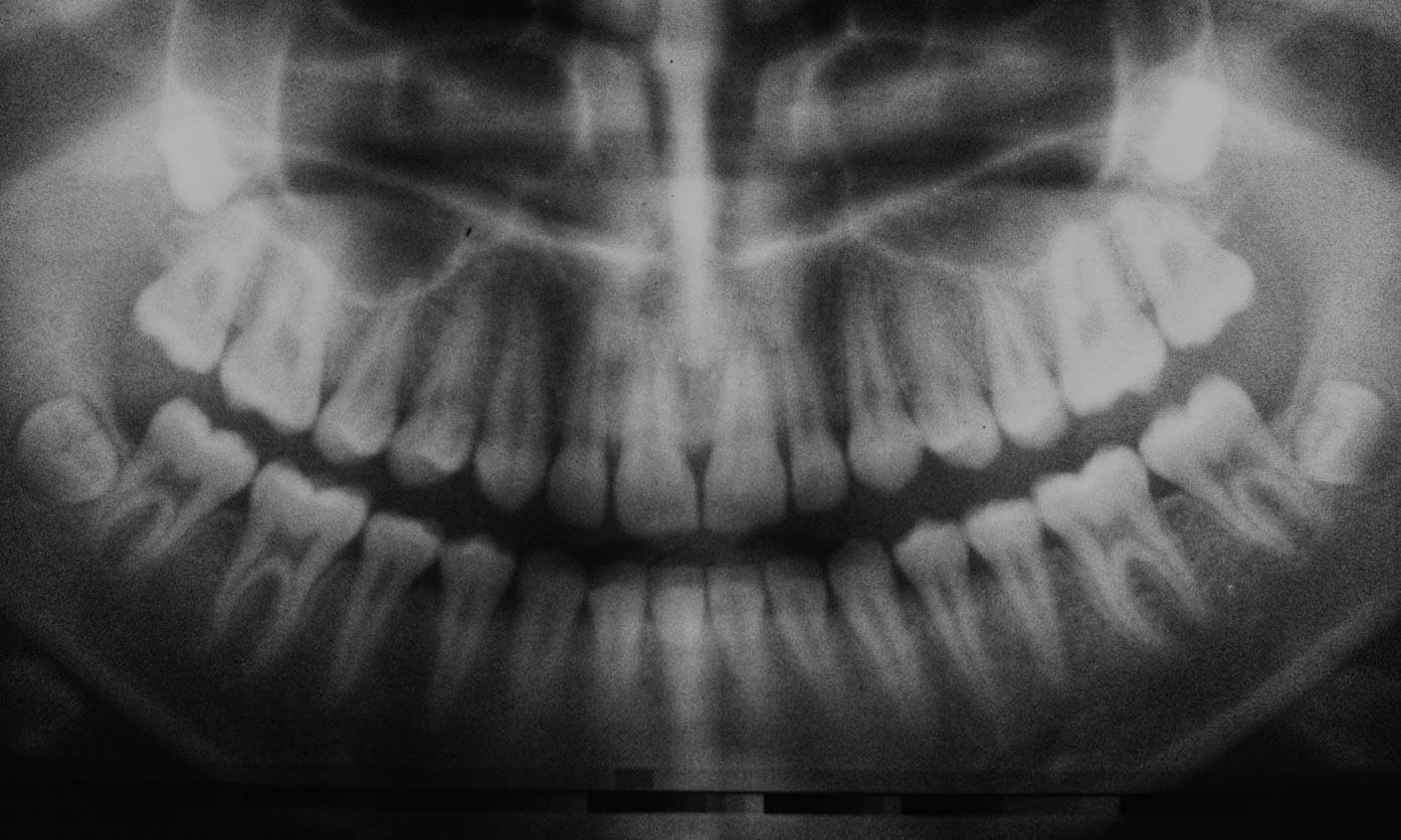 Skadad eller Trasig Tand: Råd och Behandling - Aqua Dental